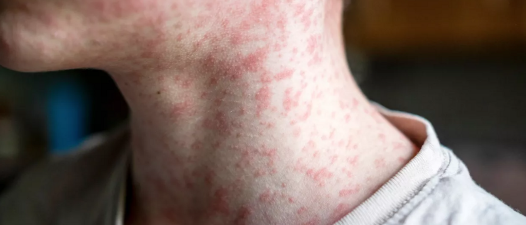 5 things to know about measles | Iowa Now - The University of Iowa